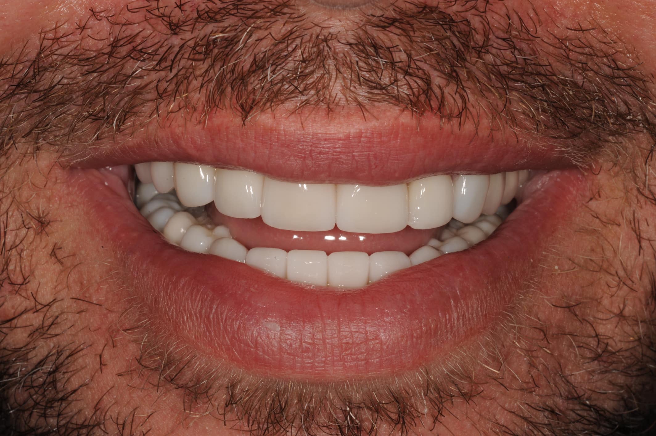 Full Mouth Reconstruction Orange County | Dr. Jack Ringer, CA Dentist