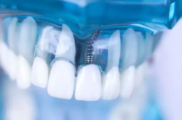Dental Implants Real Life Savers | Dr. Jack Ringer, CA Dentist